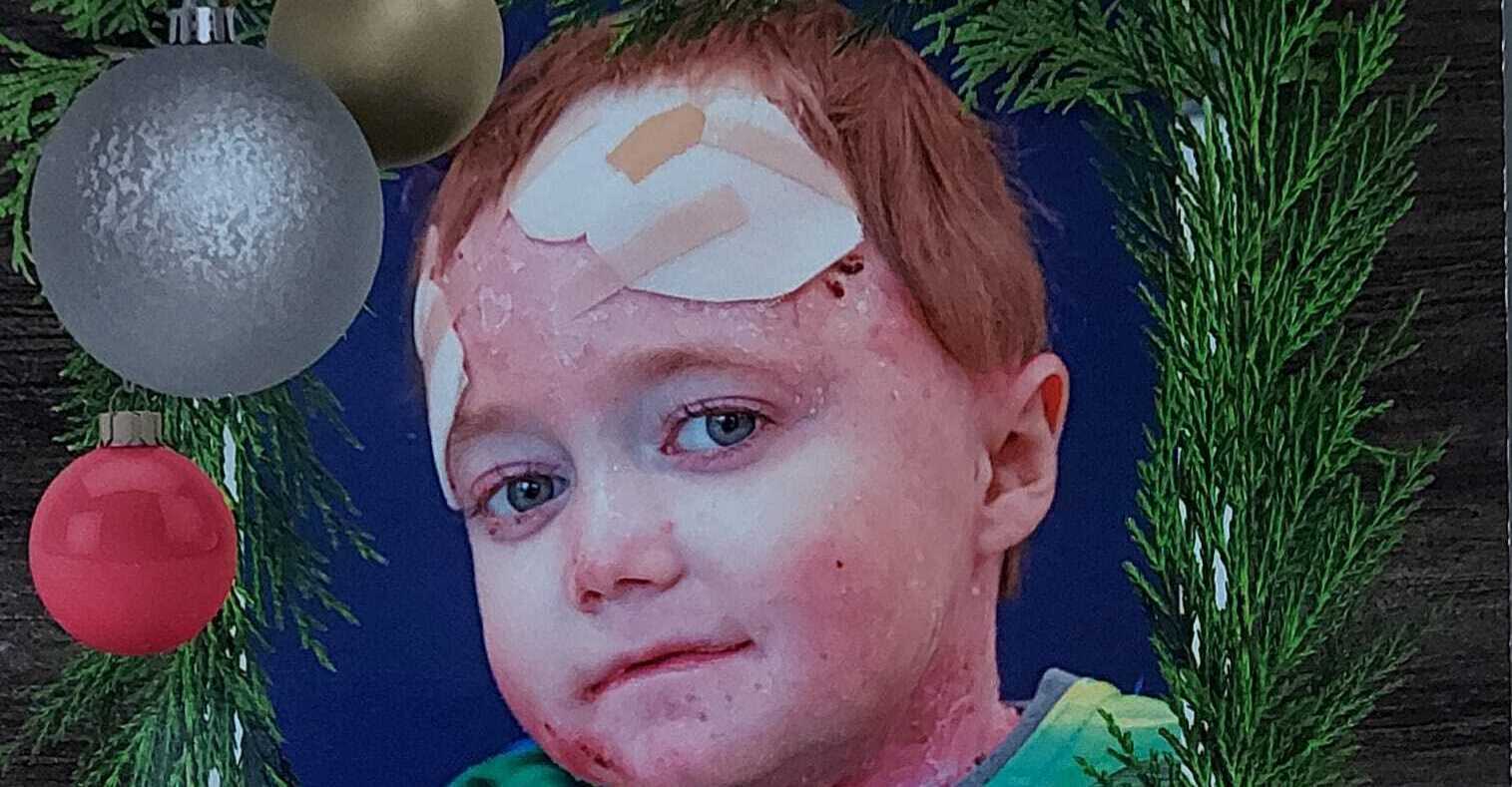 These kids have it really tough - epidermolysis bullosa 🤕💖 – Initiative ...